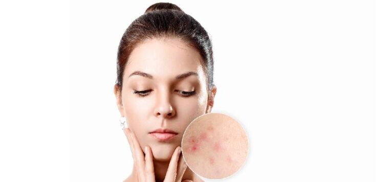 Penyebab dan Cara Mengatasi Jerawat Meradang - Farmaku.com