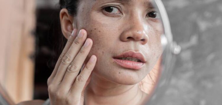 Kulit Rusak akibat Stres? Ini 10 Tips untuk Mengatasinya - Farmaku.com
