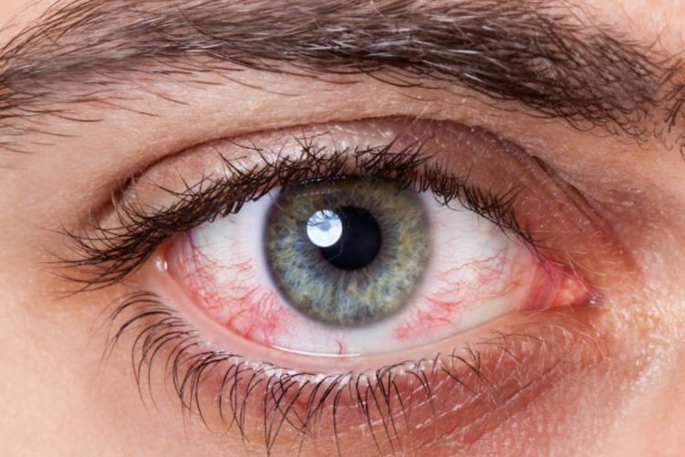 Ini 11 Produk Cendo untuk Mengobati Infeksi Mata